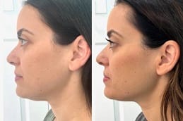 Fat Melting Injections in Dubai | Injection to Melt Fat Away